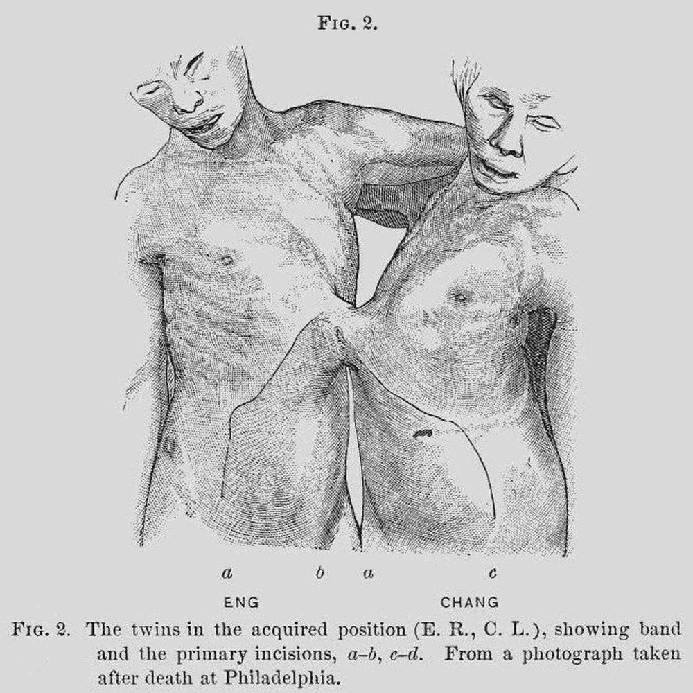 Report of an autopsy on the bodies of Chang and Eng Bunker, commonly known as the Siamese twins ...