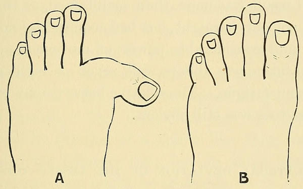 The deformities of the fingers and toes by William Anderson (1842~1900)